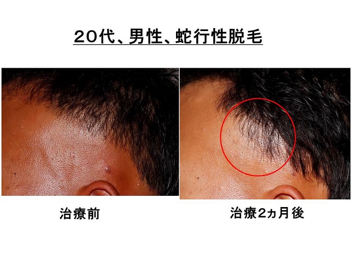 蛇行性脱毛の患者様、治療2ヵ月で、もう産毛が生えてきました！ 患者様からの声・メディア掲載・クリニックからのお知らせ 名古屋kクリニック